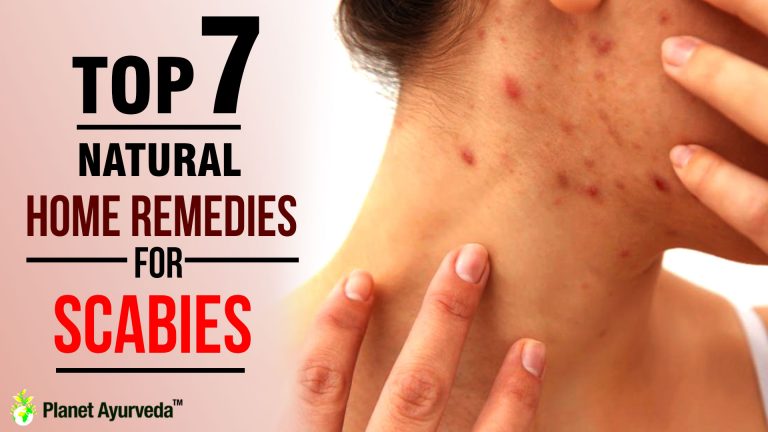 Top 7 Natural Home Remedies for Scabies