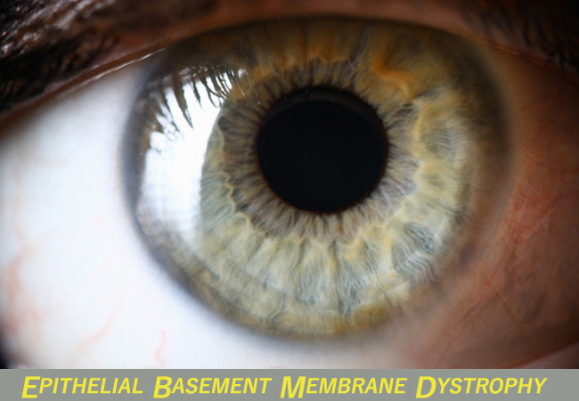 Epithelial Basement Membrane Dystrophy