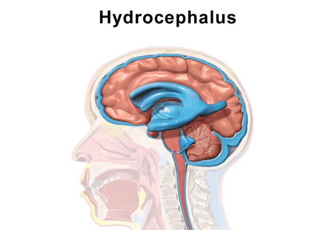Different Types of Hydrocephalus and Ayurvedic Treatment