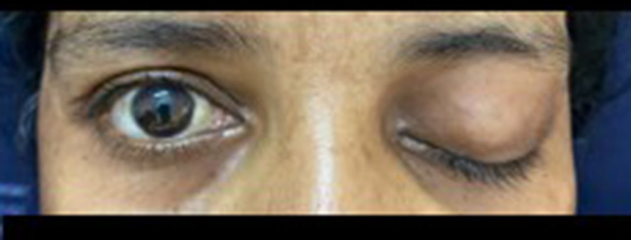 Ayurvedic Treatment of Rhino ocular cerebral mucormycosis