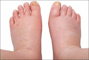 Treatment of Anasarca in Ayurveda with Herbal Remedies