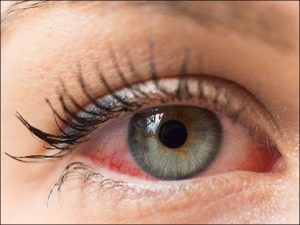 Ocular Surface Disease (OSD) Treatment in Ayurveda